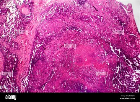 Caseous Pneumonia Light Micrograph Photo Under Microscope