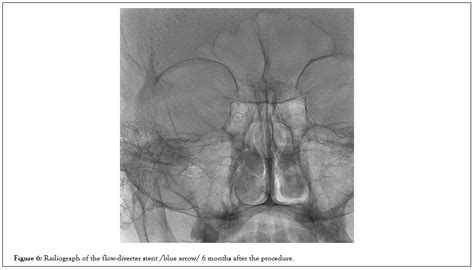 A Rare Case Of Flow Diversion Of A Fenestration Of The Internal Carotid Artery With An