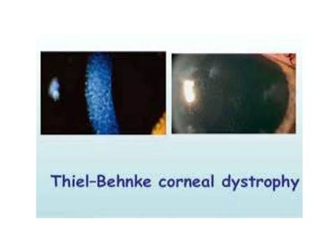 Corneal Dystrophy And Degeneration Pptx