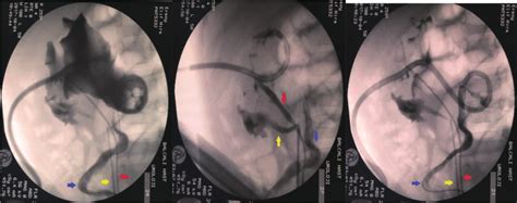Retrograde Pyelogram Demonstrates Triplicate Of Ureters And