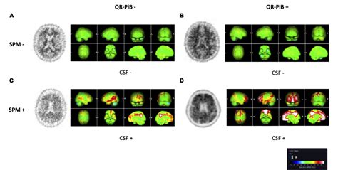 Figure 1 From Statistical Parametric Mapping In Amyloid Positron Emission Tomography Semantic