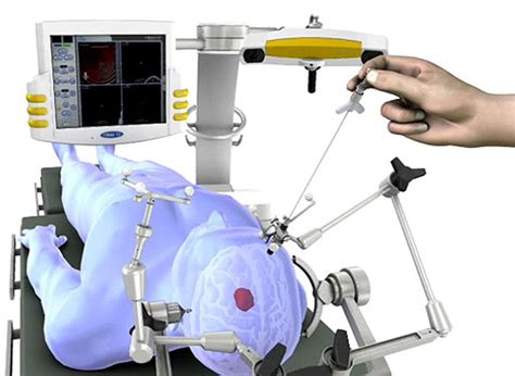 Navigation System Brain Surgery At Dane Goodnight Blog