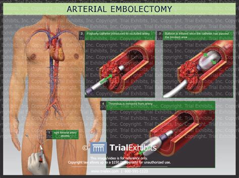 Arterial Embolectomy Trial Exhibits Inc