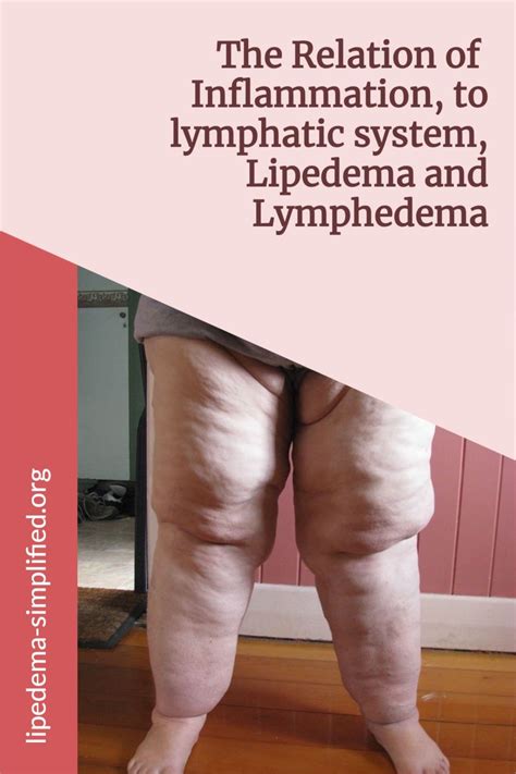 Patient Guide To Self Diagnosing Lipedema And Lipo Lymphedema Artofit