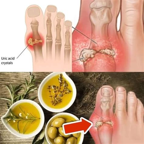 8 Easy Ways To Remove Excess Uric Acid Easier Than You Think