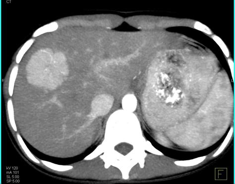 Focal Nodular Hyperplasia Fnh Liver Radiology Case Studies Ctisus