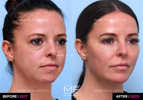 Cheeks Before And After Pictures Case 1055 San Francisco Ca Mabrie