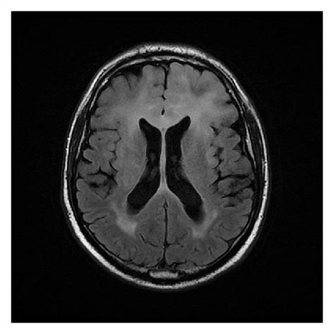 Multiple Sclerosis Plaque In The Isthmus Of The Corpus Callosum Fse Download Scientific