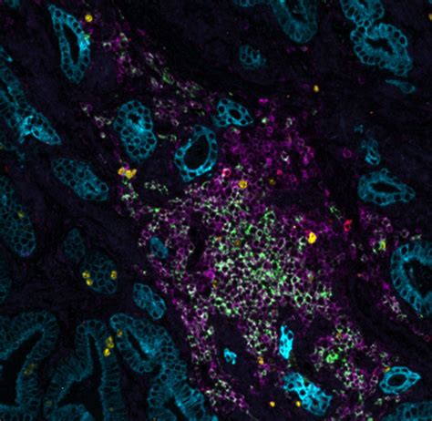 exploring spatial insights between tumor and stroma with multiplex
