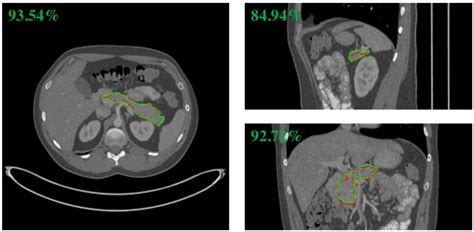 Globally Guided Progressive Fusion Network For 3d Pancreas Segmentation