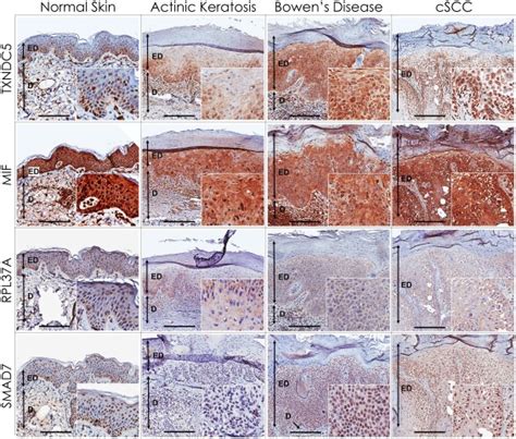 Differential Proteomic Analysis Of Actinic Keratosis Bowens Disease And Cutaneous Squamous