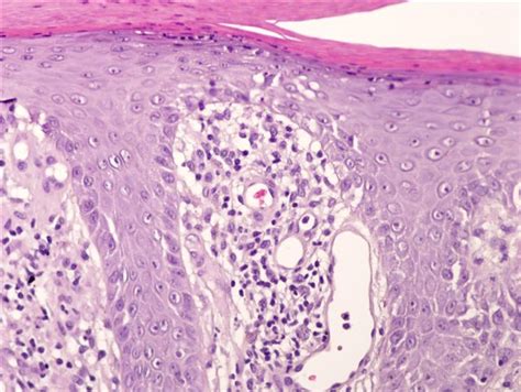 Pathology Outlines Psoriasis