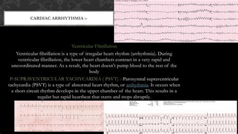 Common Signs And Abnormalities Can Detect In Cardiac Monitorpptx