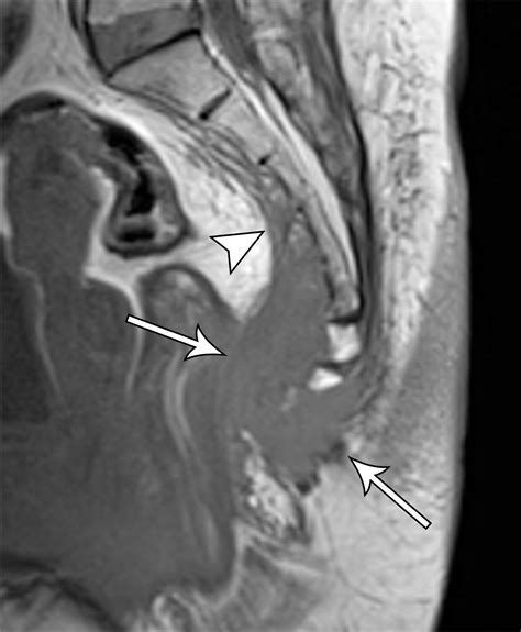Imaging Coccygeal Trauma And Coccydyniaradiographics