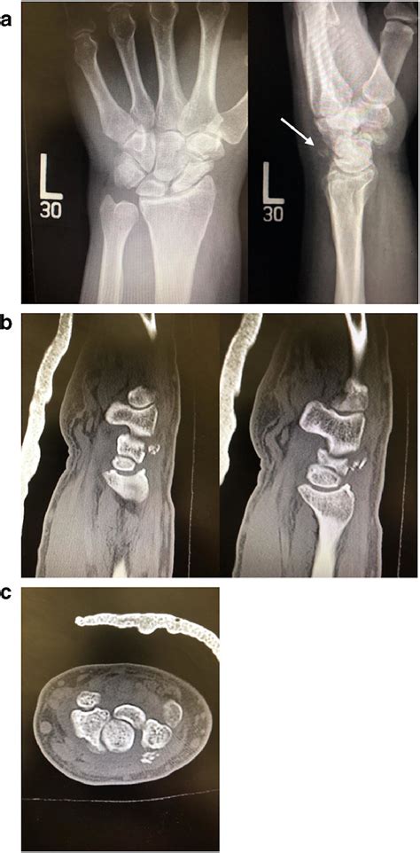 Dorsal Cortical Fracture Of The Triquetrum A Pa And Lateral