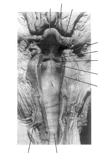 Ventricular Folds Cadaver Choroid Plexus Of The Fourth Ventricle