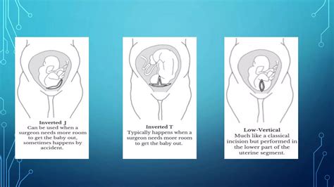 Pregnancy With Previous Cesarean Section Pptx Pregnancy Reproductive Health
