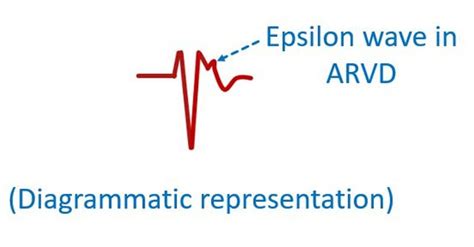 Epsilon Wave All About Cardiovascular System And Disorders
