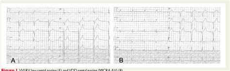 Figure 1 From A New Leadless Pacemaker With Atrioventricular