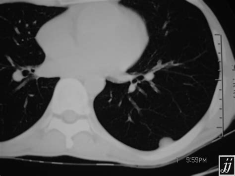 Osteosarcoma Metastasis Radiopaedia