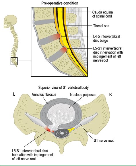 Cauda Equina Syndrome Red Flags