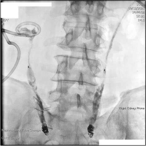 Final Nephrostogram Demonstrating No Contrast Leakage Beyond Download Scientific Diagram