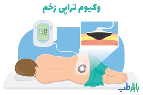 وکیوم تراپی زخم بازارطب