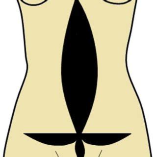 Bilateral Extension Of The Horizontal Fleur De Lis Incision Through The