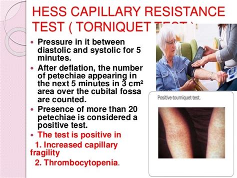 Investigation Of Purpuric Rash