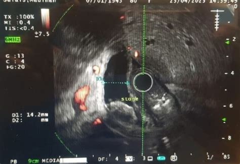 Eus Ercp Advance Kfhu Turki Alamri