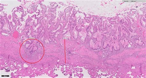 Biliary Hyperkinesia As An Indication For Cholecystectomy In The