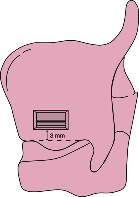 Medialization Laryngoplasty And Arytenoid Adduction Clinical Tree