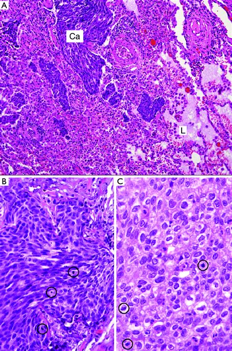 Keratinizing Squamous Cell Carcinoma Cutaneous Squamous Cell