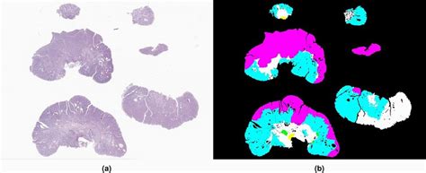Example Of A Whole Slide A From The Crc Dataset Manual Segmentations