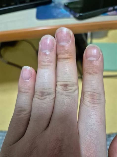 손가락 끝 변색 지식in