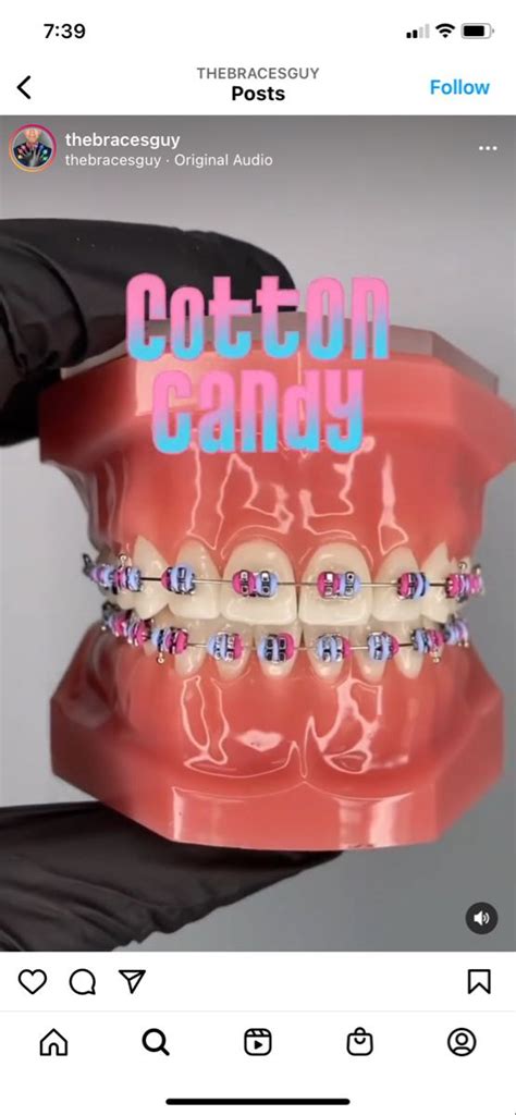Cotten Candy Braces Braces Colors Cute Braces Cute Braces Colors