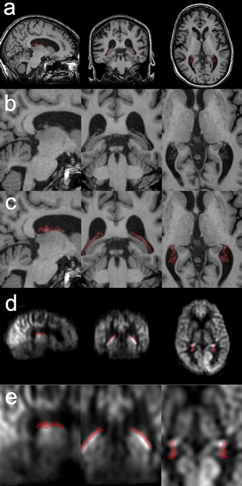 Choroid Plexus Regions Segmented Based On T Weighted Images The Download Scientific Diagram