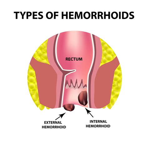 External Hemorrhoids Vs Skin Tags