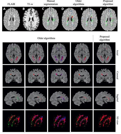 Cnn Algorithms For Automated Ms Lesion Segmentation In The Upper Part