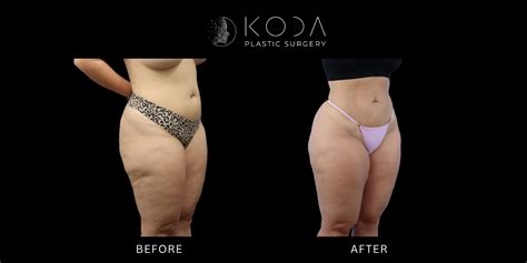 Skinny Bbl In Scottsdale Az Natural Butt Lift Results