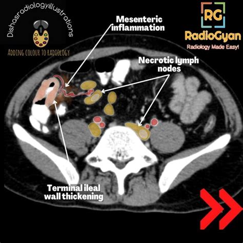 Ileocecal Tuberculosis Radiology Case Radiogyan