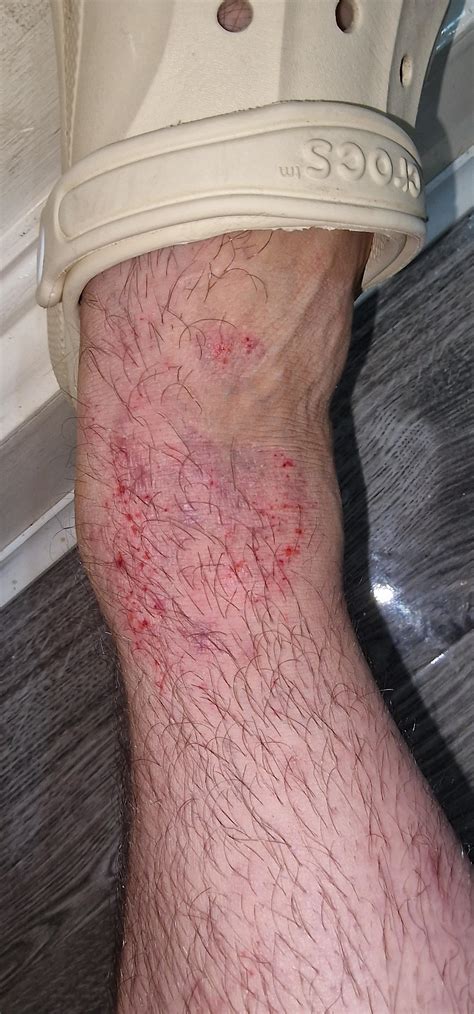 Is This Ring Worm Rdiagnoseme