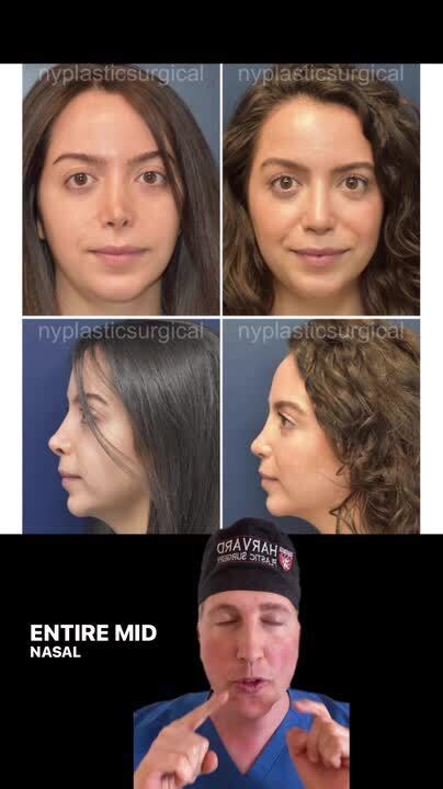 Morselized Bone Dorsal Onlay Graft Video Realself