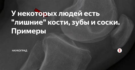У некоторых людей есть лишние кости зубы и соски Примеры Наукоград Дзен