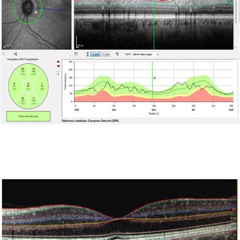 macular segmentation macular scan obtained with spectral domain
