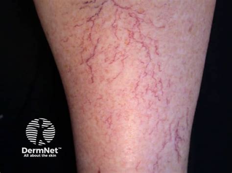 Unilateral Nevoid Telangiectasia Acquired Spider Unilateral Nevoid