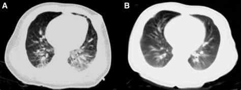 Metagenomics Next Generation Sequencing Assists In The Diagn Medicine