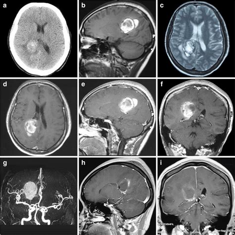 Case 12 Axial Ct A Demonstrating A Hyper Density Lesion Located In Download Scientific