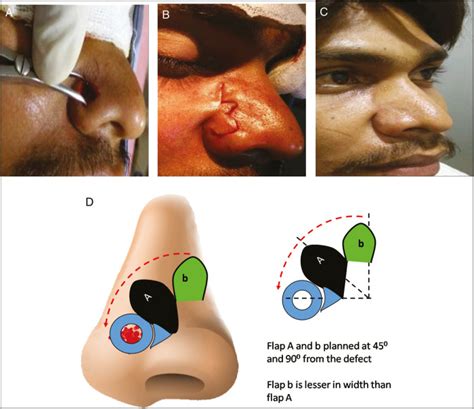 Nose Reconstruction Using Local And Regional Flaps The Challenges And Advantages Pmc