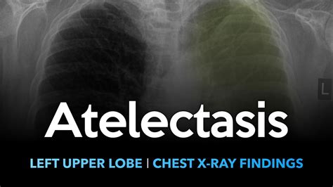 What Is Atelectasis In Chest X Ray At Marisa Randolph Blog